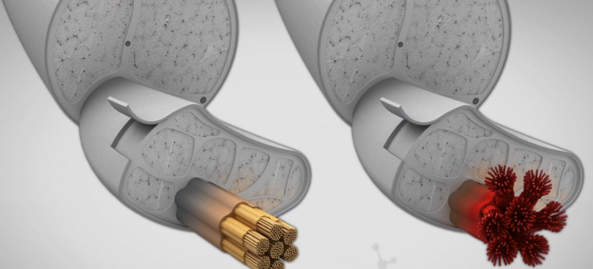 Tendinopathy in Australian Rules Football - La Trobe Sport and Exercise ...