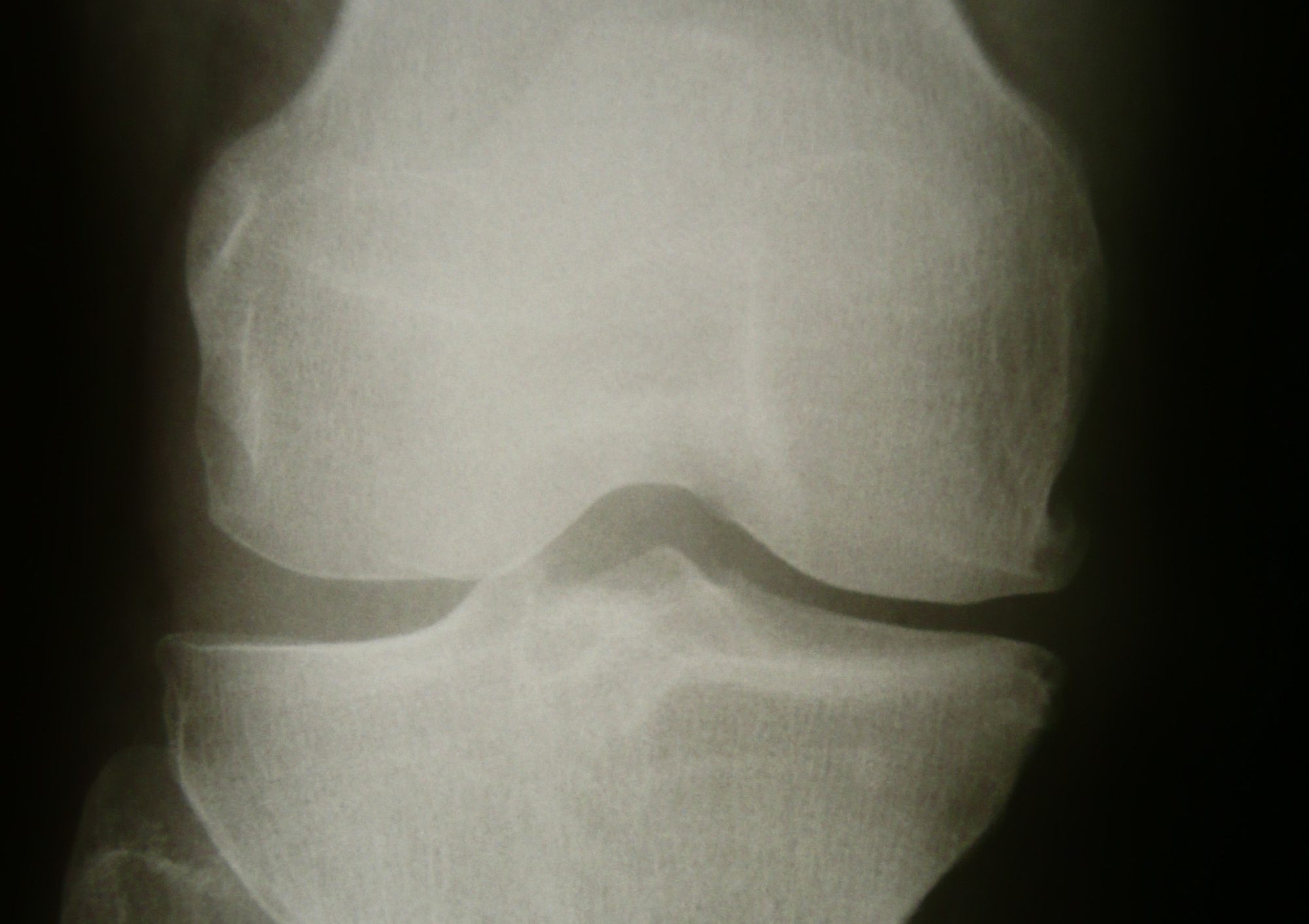 4 key differences between post-traumatic and non-traumatic knee ...